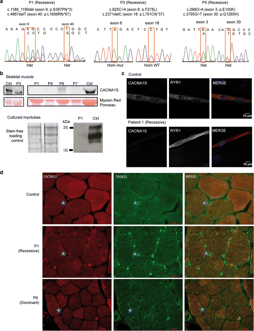 Dihydropyridine receptor (DHPR, CACNA1S) congenital myopathy | SpringerLink