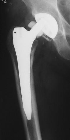 Fracture of ceramic heads in total hip replacement | SpringerLink