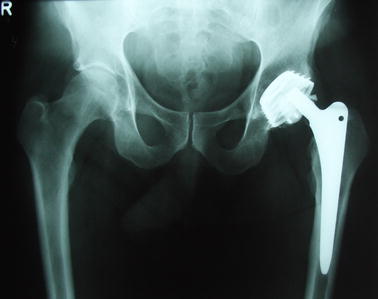 Fracture of ceramic heads in total hip replacement | SpringerLink
