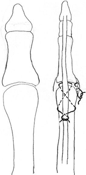 Arthroscopic-assisted correction of claw toe or overriding toe ...