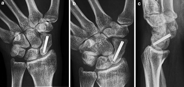 Fixation of nondisplaced scaphoid fractures: making treatment cost ...