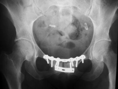 Internal fixation of traumatic diastasis of pubic symphysis: is plate ...