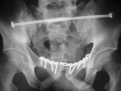 Internal fixation of traumatic diastasis of pubic symphysis: is plate ...