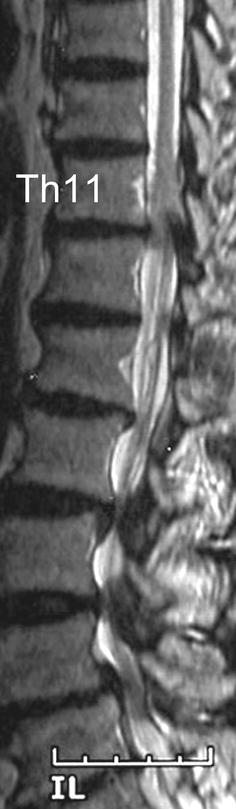 Two-stage decompression for combined epiconus and cauda equina syndrome ...