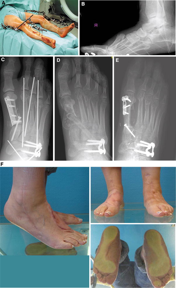 Osteo-fasciocutaneous parascapular flap transfer for reconstruction of ...
