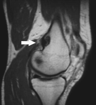 Cortical desmoid and the four clinical scenarios | SpringerLink
