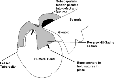 A modification of the McLaughlin procedure for persistent posterior ...