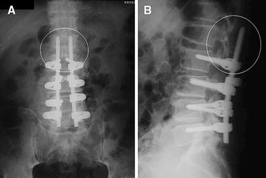Sublaminar wiring stabilization to prevent adjacent segment ...
