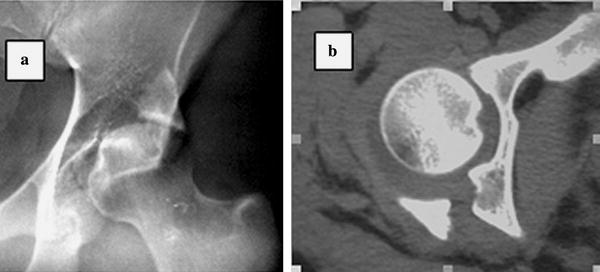 Digastric trochanteric flip osteotomy and surgical dislocation of hip ...