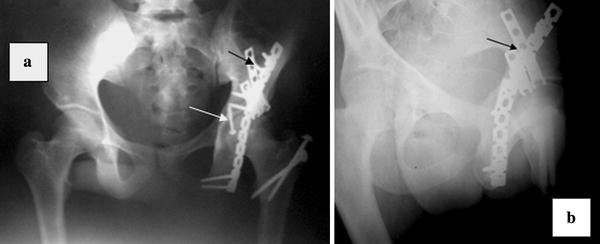 Digastric trochanteric flip osteotomy and surgical dislocation of hip ...