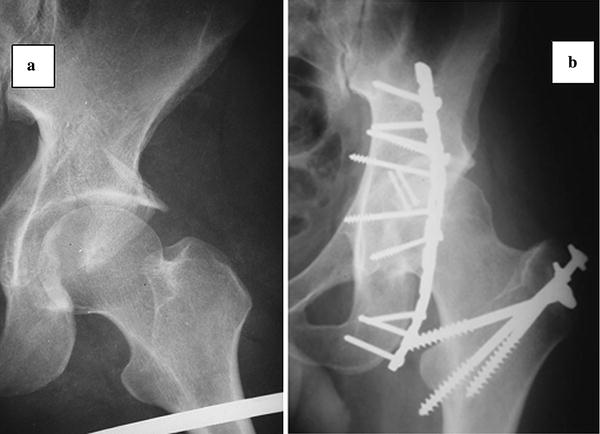 Digastric trochanteric flip osteotomy and surgical dislocation of hip ...
