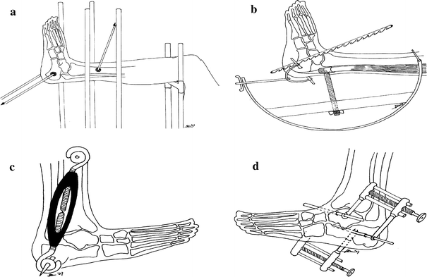 Treatment of displaced intra-articular calcaneal fractures by ...