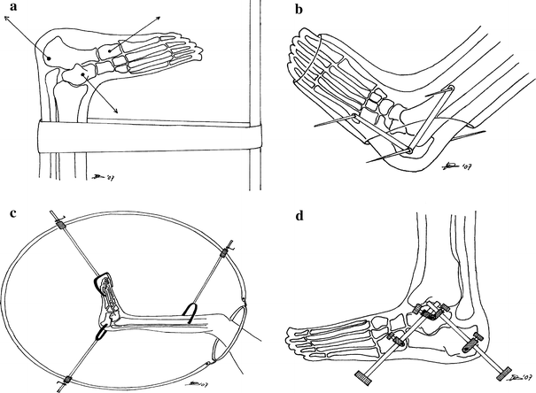 Treatment of displaced intra-articular calcaneal fractures by ...