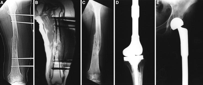 Total femur replacement | SpringerLink