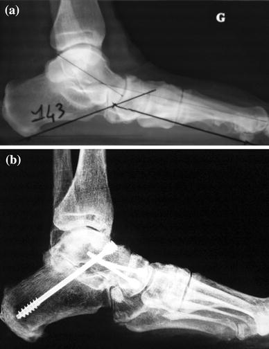 Arthrodesis of the subtalar and talonavicular joints through a medial ...