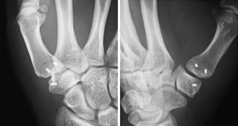 Surgical reconstruction using suture anchor for dislocation of the ...