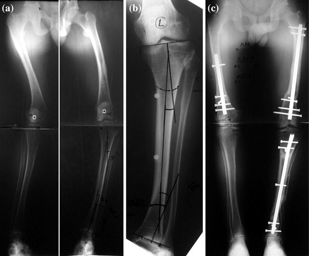 Comparison of fixator-assisted nailing versus circular external fixator ...