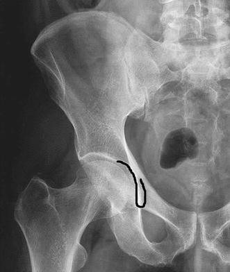 Isolated fractures of the teardrop of the acetabulum | SpringerLink