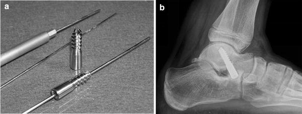 Calcaneo-stop procedure for paediatric flexible flatfoot | SpringerLink