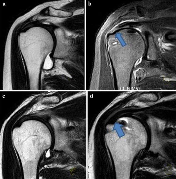 Transtendon arthroscopic repair of high grade partial-thickness ...
