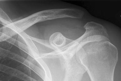 Hook plate fixation for acromioclavicular joint separations restores ...