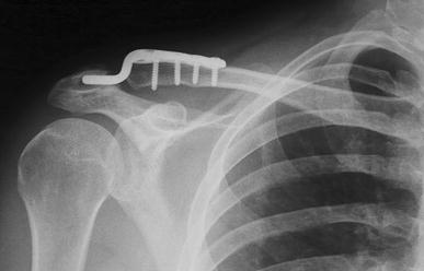 Hook plate fixation for acromioclavicular joint separations restores ...