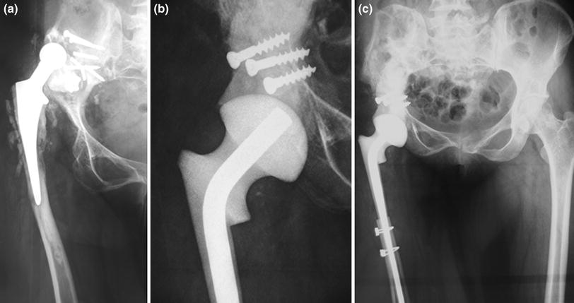 Temporary cement tectoplasty: a technique to improve prefabricated hip ...