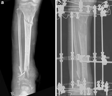 Treatment of an open distal tibia fracture with segmental bone loss in ...