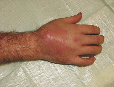Tuberculous extensor tenosynovitis of the hand | SpringerLink