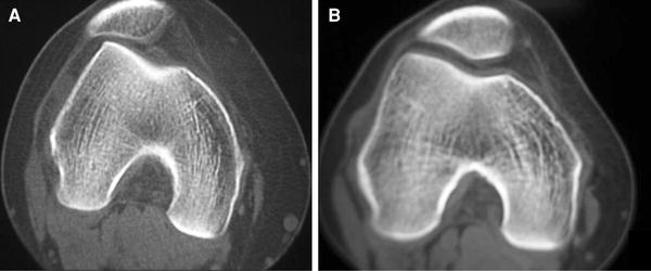 Medial patellar retinaculum plasty versus medial capsule reefing for ...