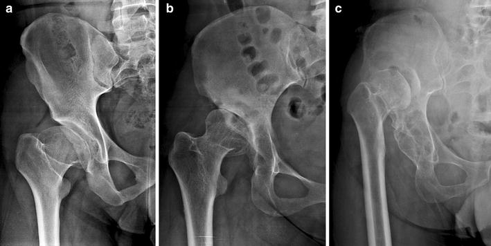 Inter- and intraobserver reliability of the Crowe and Hartofilakidis ...