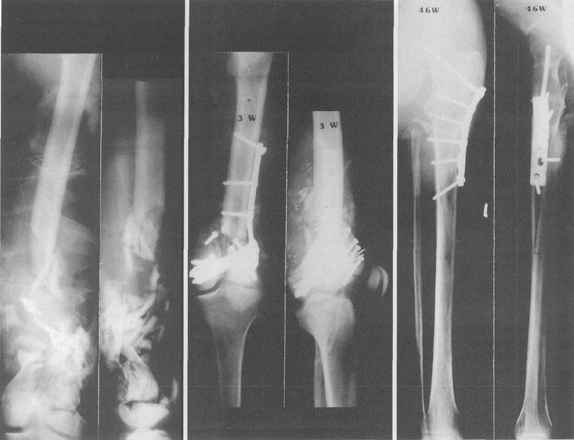 Eighteen-year follow-up after rotationplasty for a grade IIIC open ...