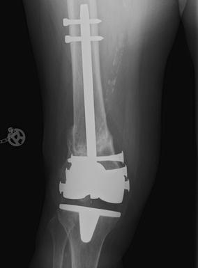 Fixation of supracondylar femoral fractures following total knee ...