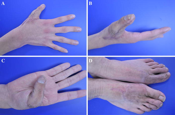 Repair of a degloving injury of the thumb with a combined dorsal great ...