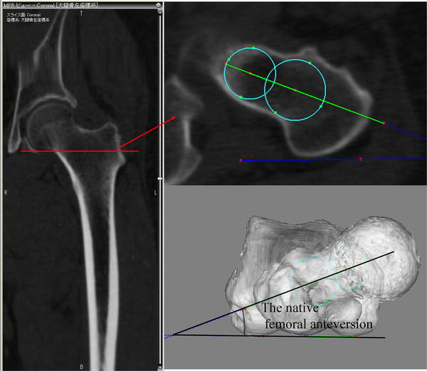 The T-line as an intraoperative landmark for reproducing the native ...