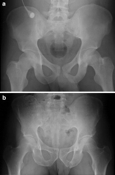 Displaced inferior ramus fractures as a marker of posterior pelvic ...