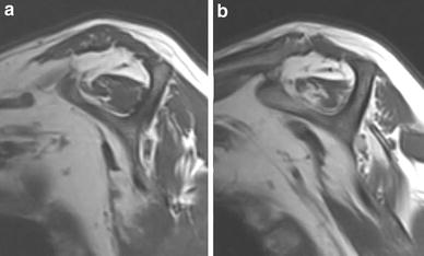 Fatty degeneration and atrophy of the rotator cuff muscles after ...