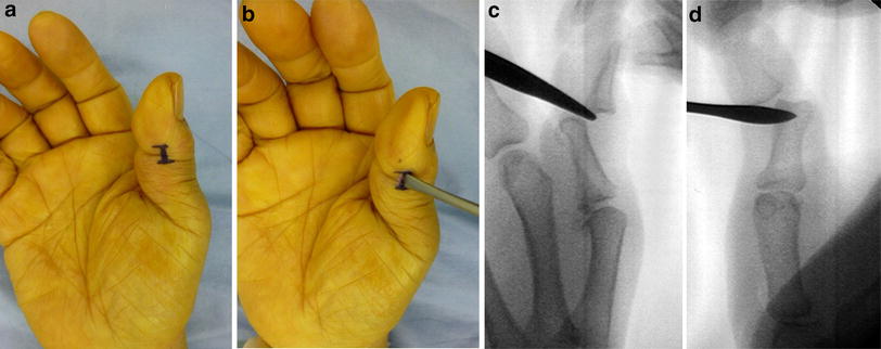 Irreducible dislocation of the thumb interphalangeal joint due to ...