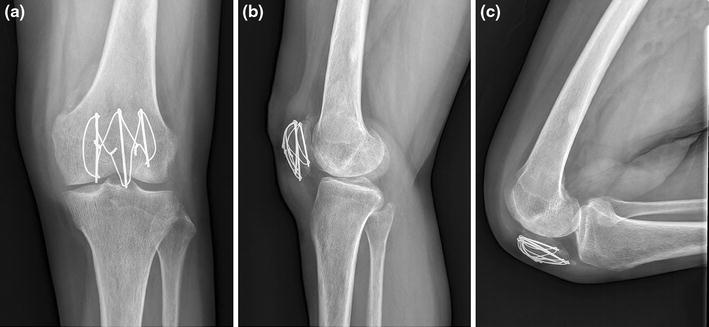 Locked tension band wiring using ring pins for patellar fractures: a ...