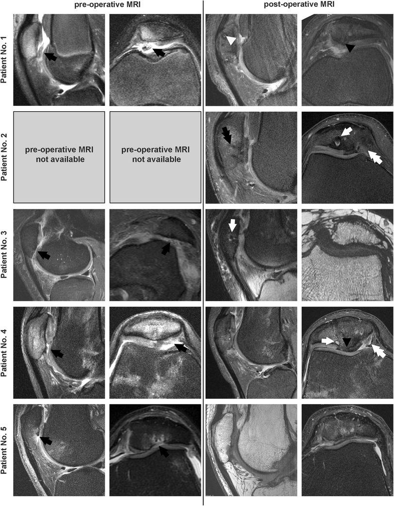 Repair of retropatellar cartilage defects in the knee with ...