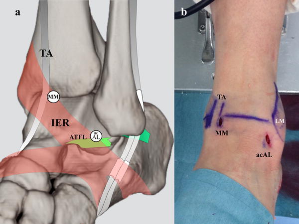 Early recovery after arthroscopic repair compared to open repair of the ...
