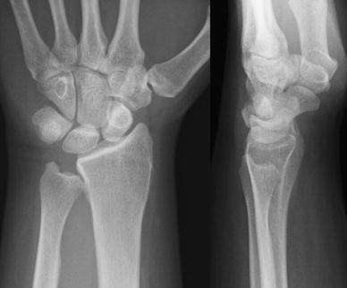 The distal radial decompression osteotomy for ulnar impingement ...