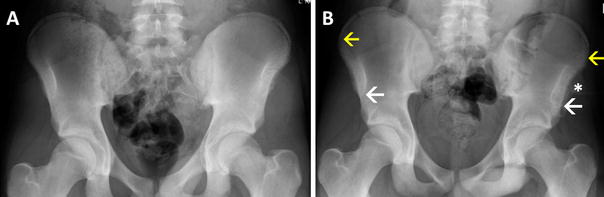 Surgical treatment of two adolescent athletes with dislocated avulsion ...
