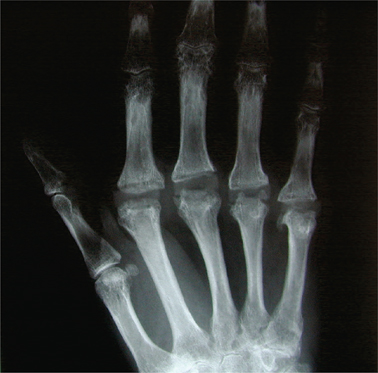 Functional and patient-reported outcomes of the Swanson metacarpo ...
