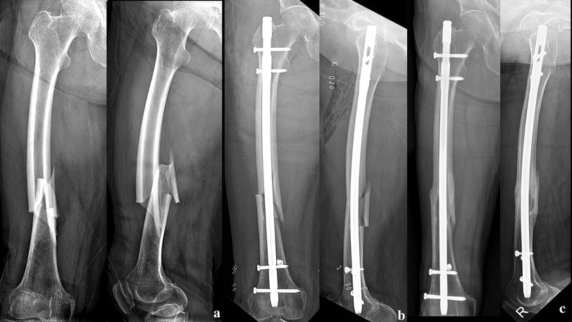 Surgical outcomes of intramedullary nailing for diaphyseal atypical ...