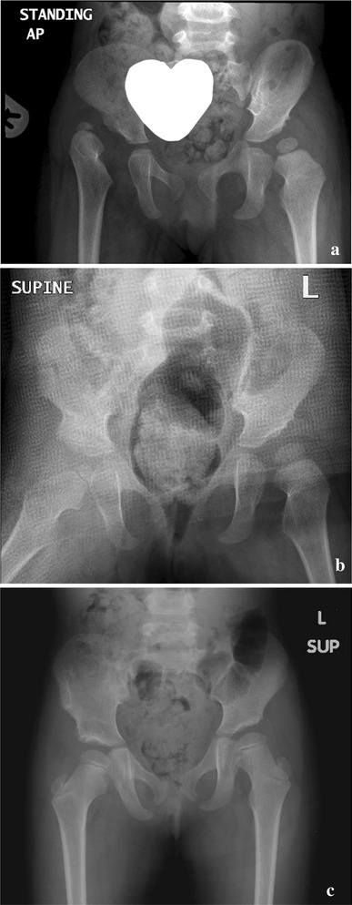 Single-leg spica provides adequate stability after open reduction in ...