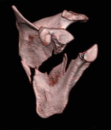 A Reverse Judet approach to the scapula | SpringerLink