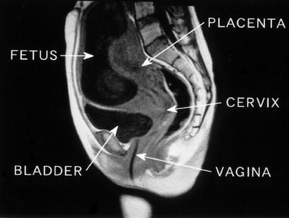 Incarceration of the retroverted gravid uterus: the key to successful ...