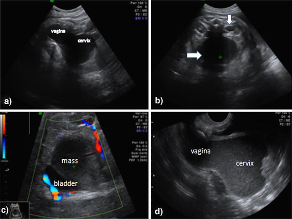 Prenatal diagnosis of imperforate hymen with hydrometrocolpos ...