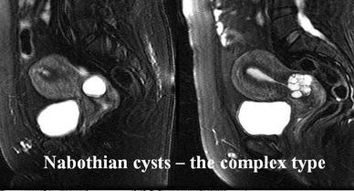 Complex Nabothian cysts: a diagnostic dilemma | SpringerLink